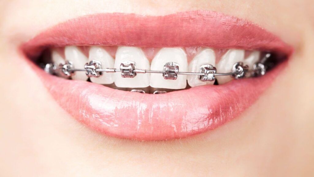 Different Types of brackets: Exploring the World of Brackets