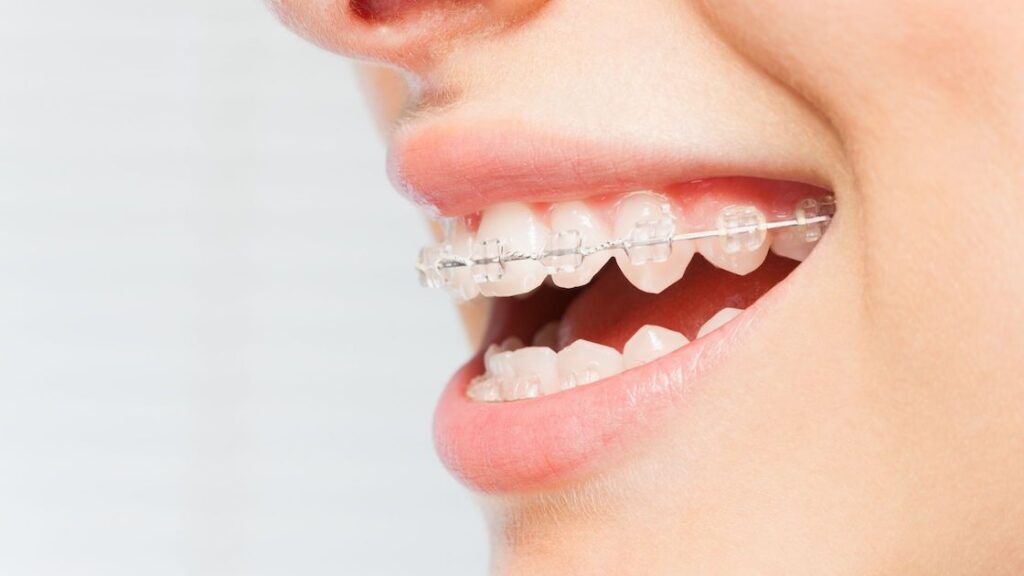 Different Types of brackets: Exploring the World of Brackets