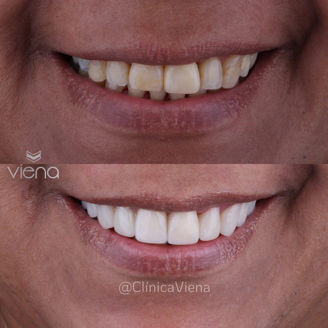 Are Veneers Bad for Your Teeth? A Dentist's Honest Answer